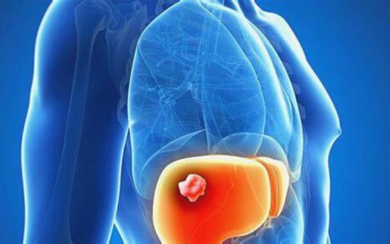 Mesures que vous pouvez prendre pour prévenir ou éviter le cancer du ...